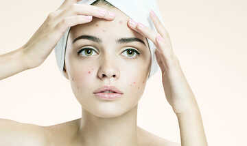 Tudo sobre a Acne!